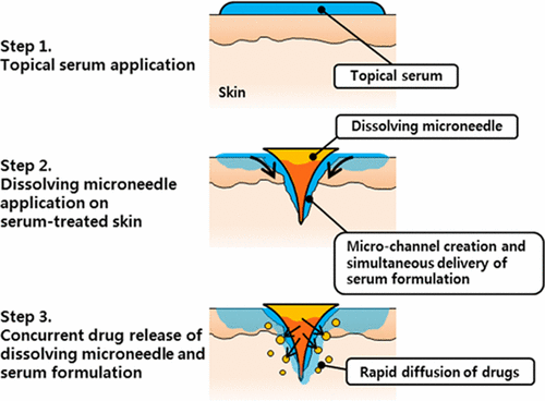 Enhanced Transdermal Delivery by Combined Application of Dissolving ...