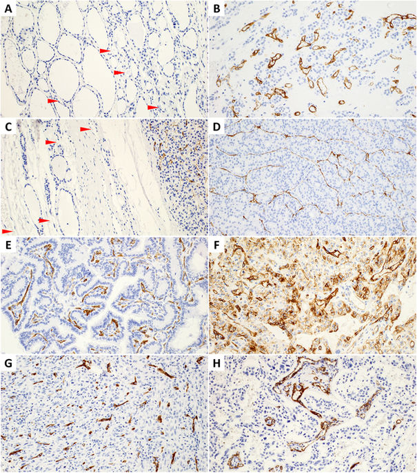 PSMA expression by microvasculature of thyroid tumors - Potential implications for PSMA ...