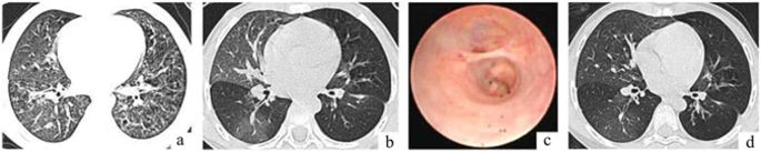 急性支气管炎后与肺炎支原体相关的闭塞性细支气管炎患者。,Scientific Reports - X-MOL