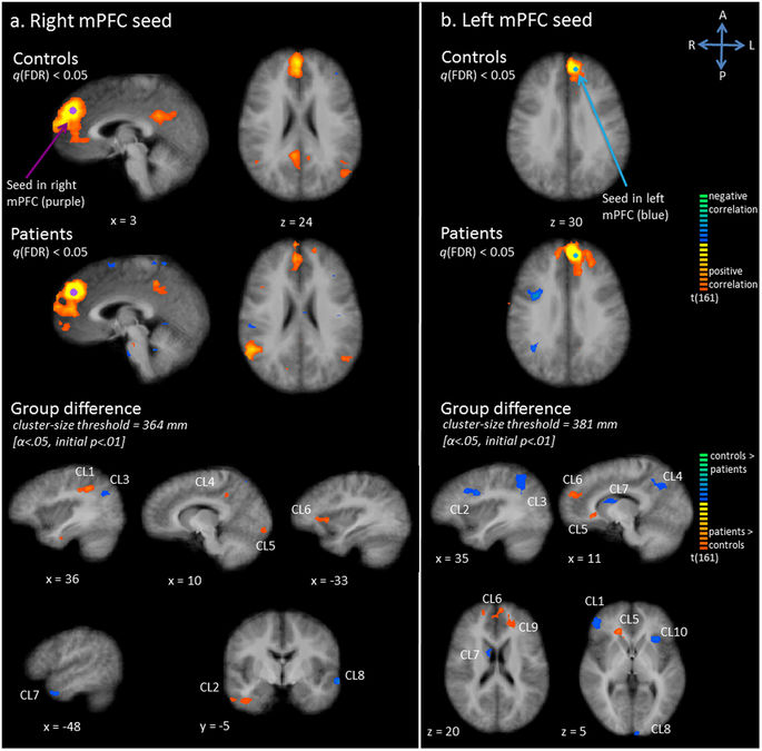 Exploration of the Brain in Rest: Resting-State Functional MRI Abnormalities in Patients with ...