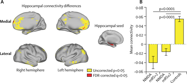 抗NMDA受体脑炎患者大规模脑网络的功能连通性：一项观察性研究。,The Lancet - X-MOL