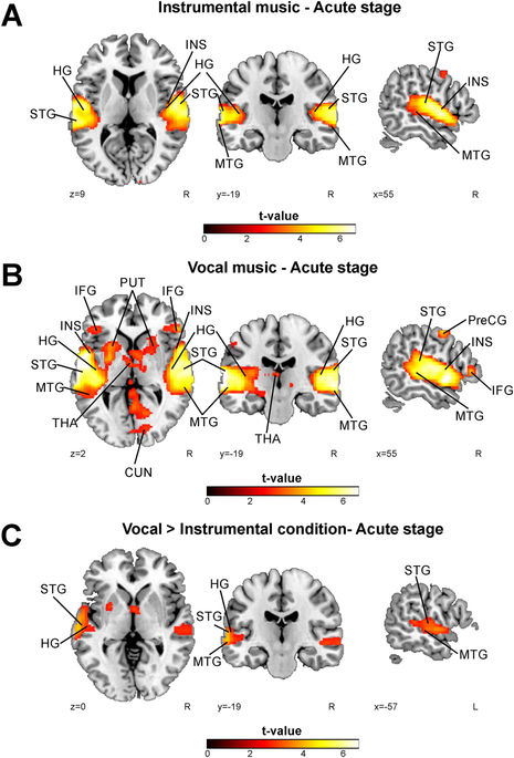 Functional neural changes associated with acquired amusia across ...
