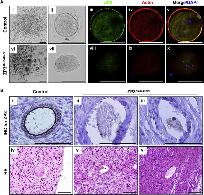ZP3的反复错义突变导致空卵泡综合征和女性不育。,American Journal of Human Genetics - X-MOL