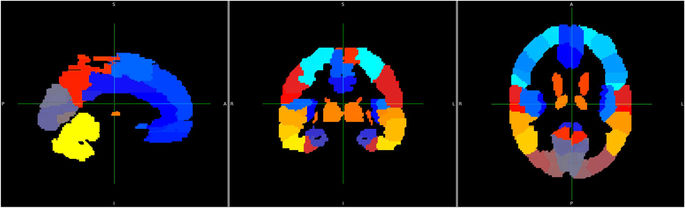 Partial volume correction for PET quantification and its impact on brain network in Alzheimer's ...
