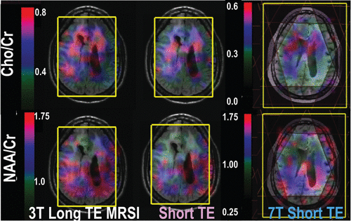 Comparison between Short and Long Echo Time Magnetic Resonance ...