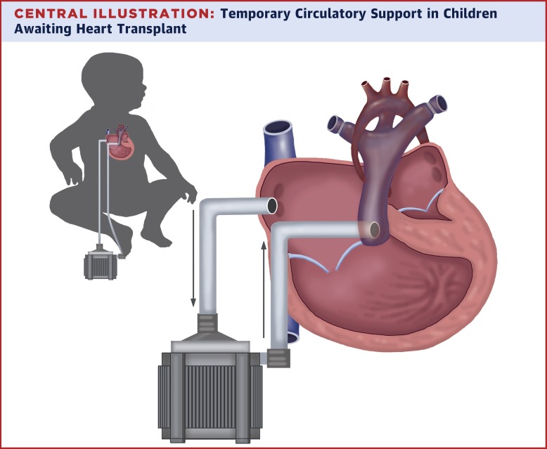 Temporary Circulatory Support in U.S. Children Awaiting Heart ...