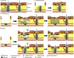 Restoration of skin pigmentation after deep partial or full-thickness ...