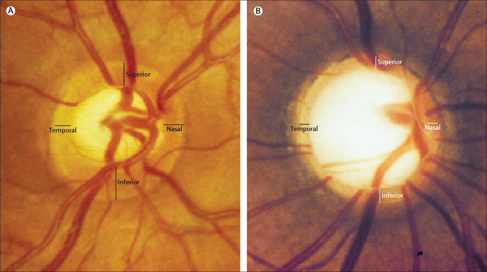 Glaucoma,The Lancet - X-MOL