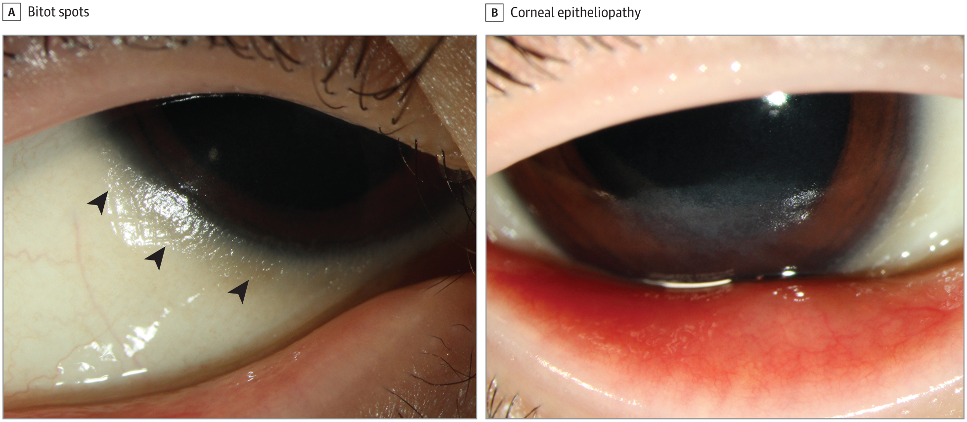 An 11-Year-Old Boy With Vision Loss,JAMA Pediatrics - X-MOL