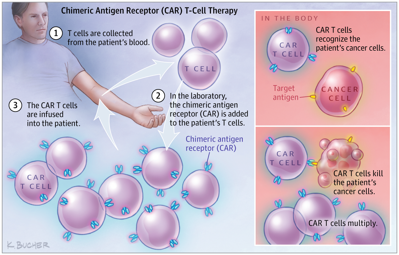 The Promise and Challenges of CAR-T Gene Therapy,JAMA - X-MOL