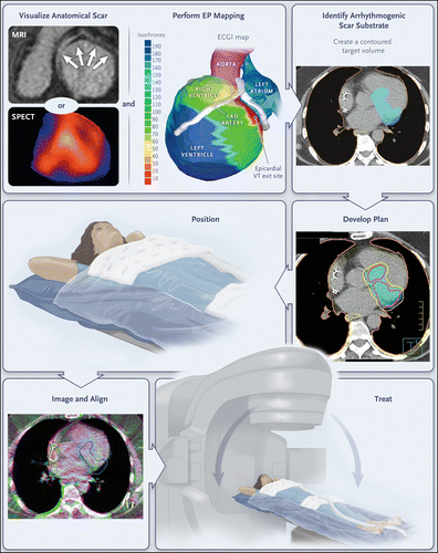 Noninvasive Cardiac Radiation for Ablation of Ventricular Tachycardia｜无 ...