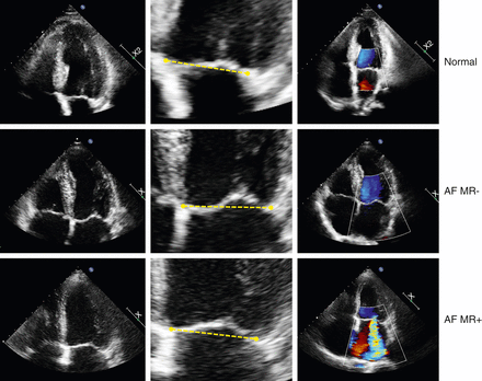 Mitral Valve Adaptation to Isolated Annular Dilation: Insights Into the ...