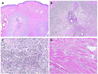 Acne keloidalis nuchae in Asian: A single institutional experience,PLOS ...