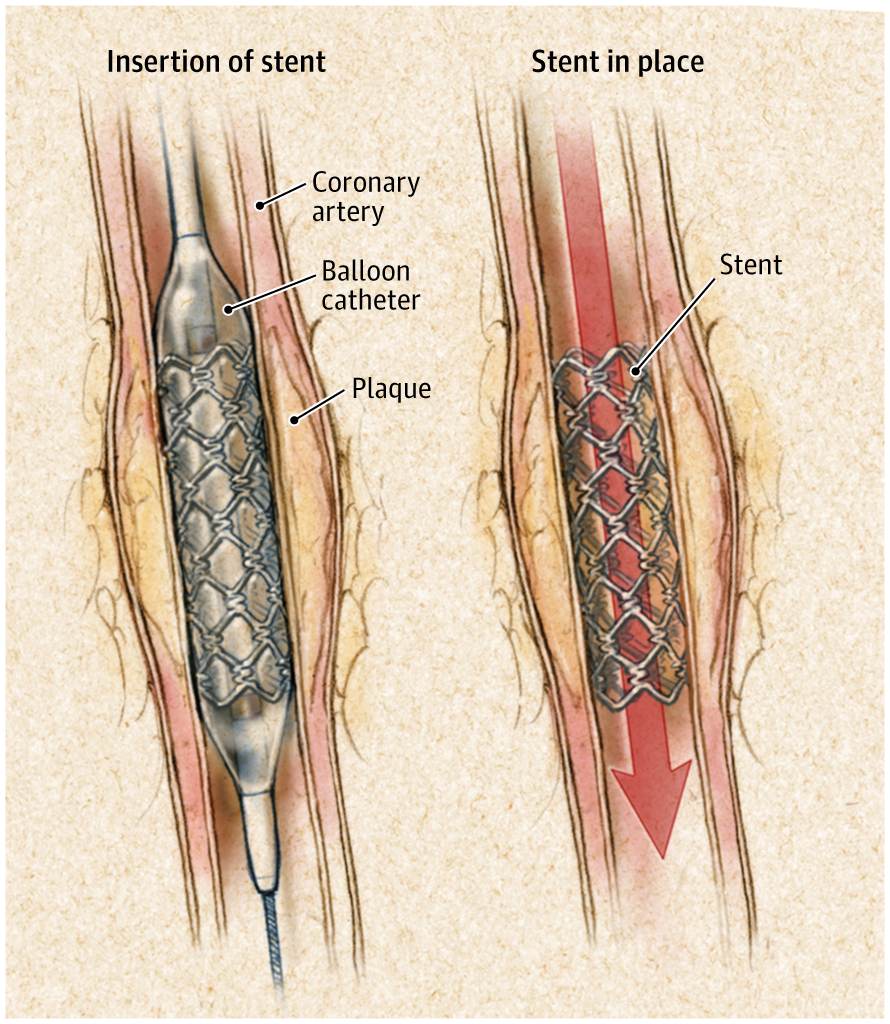 Stenting Does Not Relieve Stable Angina Symptoms,JAMA - X-MOL