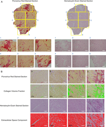 Native T1 Mapping and Extracellular Volume Mapping for the Assessment ...
