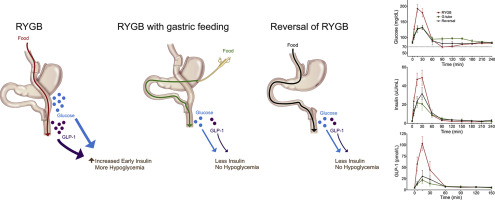 Roux en Y gastric bypass hypoglycemia resolves with gastric feeding or ...