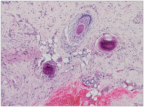 Gadolinium Presence Within Cutaneous Sclerotic Bodies Confirmed by ...