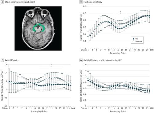 Anatomical Wiring and Functional Networking Changes in the Visual ...