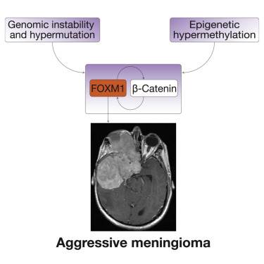Comprehensive Molecular Profiling Identifies FOXM1 as a Key Transcription Factor for Meningioma ...