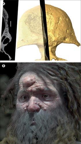 Did Cro-Magnon 1 have neurofibromatosis type 1?,The Lancet - X-MOL