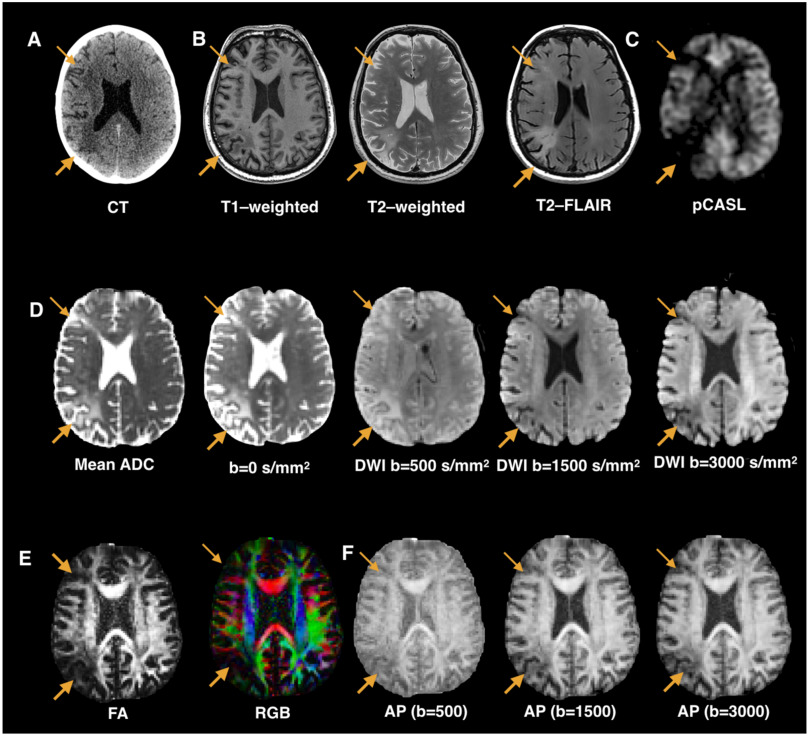 Lesion mapping in acute stroke aphasia and its implications for ...