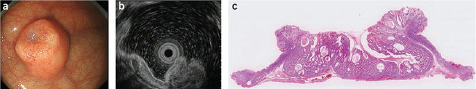 Gastric Inverted Hyperplastic Polyp Mimicking a Papilla,The American ...