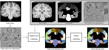 Supervoxel based method for multi-atlas segmentation of brain MR images,NeuroImage - X-MOL