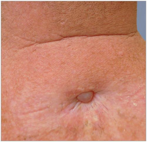 Spinal Dysraphism Presenting as a Translucent Papule in a Man,JAMA ...