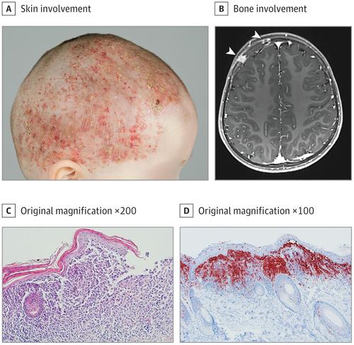 Nonhealing Crusted Scalp Lesions in a 4-Year-Old Boy,JAMA Dermatology ...