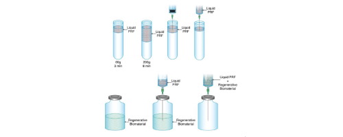 Autologous Liquid Platelet Rich Fibrin: a novel drug delivery system ...