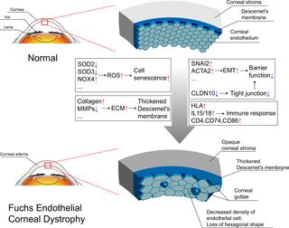 Pathological molecular mechanism of symptomatic late-onset Fuchs ...