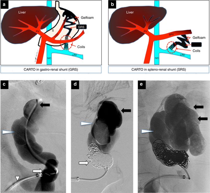 Coil-Assisted Retrograde Transvenous Obliteration (CARTO): An ...