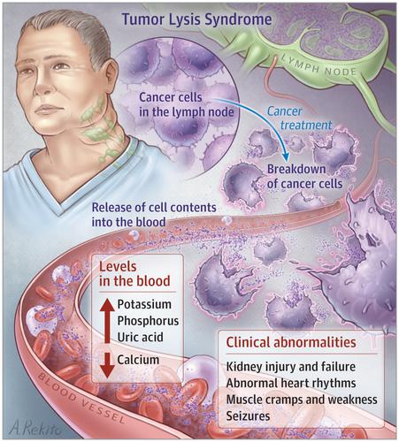 Tumor Lysis Syndrome,JAMA Oncology - X-MOL