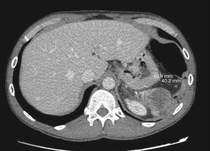 Aseptic Abscess Syndrome, a Case of Prolonged Remission Following ...