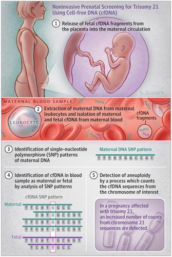 Noninvasive Prenatal Genetic Screening Using Cell-free DNA,JAMA - X-MOL