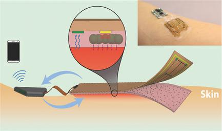 Smart Bandage for Monitoring and Treatment of Chronic Wounds,Small - X-MOL