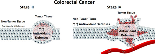 Non-tumor adjacent tissue of advanced stage from CRC shows activated ...