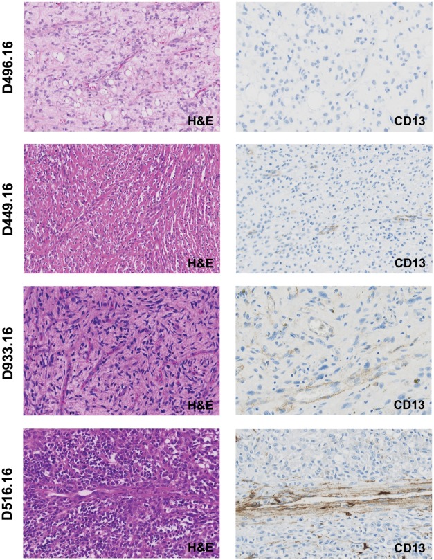 Aminopeptidase N (CD13): Expression, Prognostic Impact, and Use as ...
