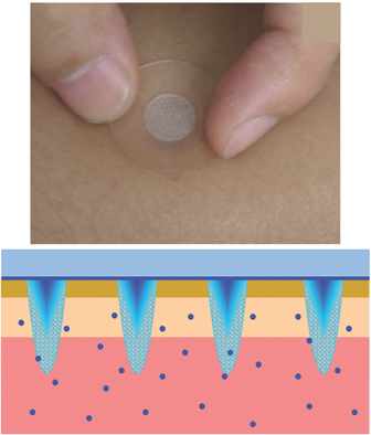 Phase‐Transition Microneedle Patches for Efficient and Accurate ...