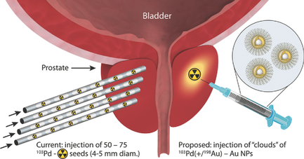 Low‐Dose Prostate Cancer Brachytherapy with Radioactive Palladium–Gold ...