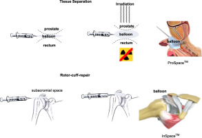 Biodegradable inflatable balloons for tissue separation,Biomaterials ...