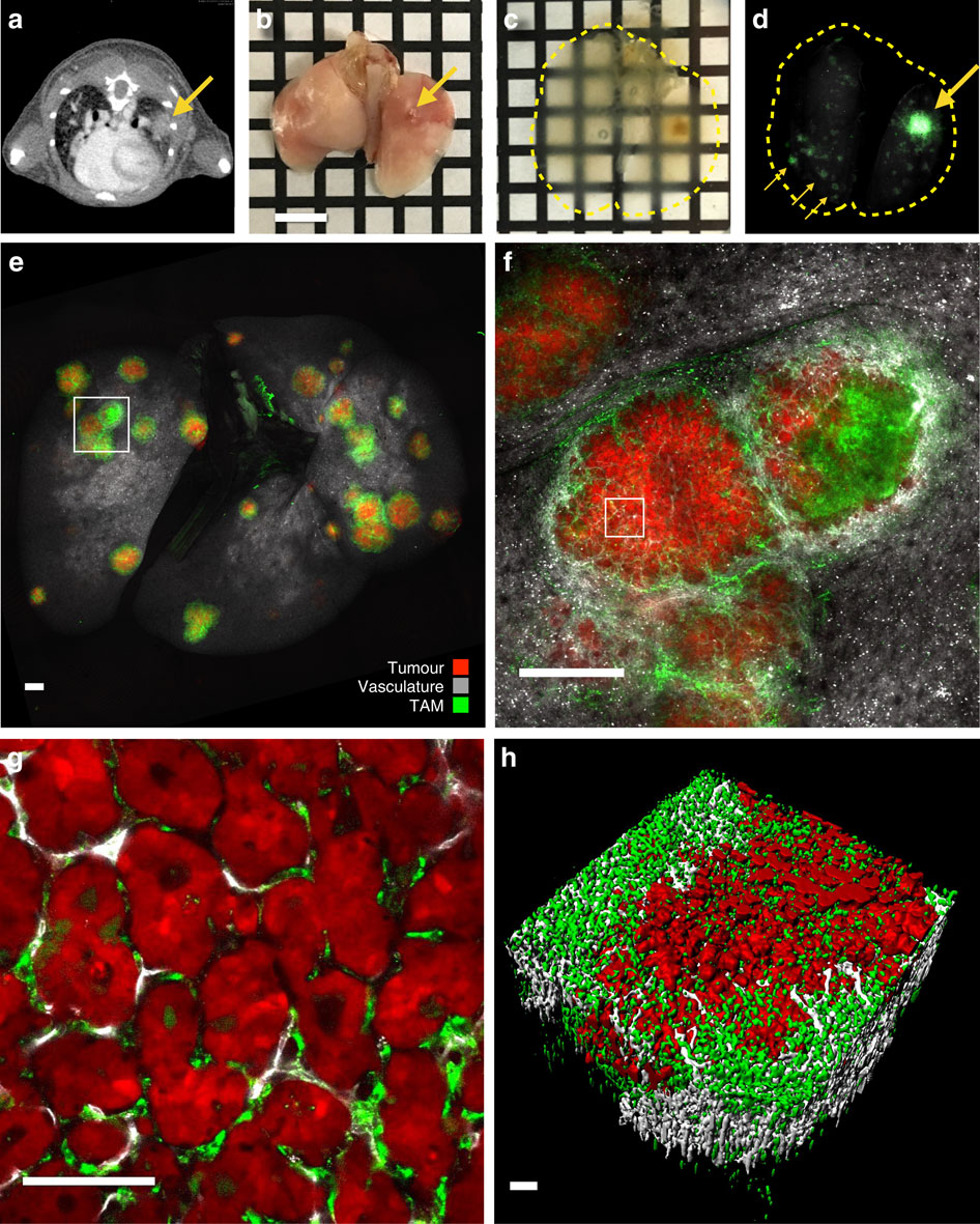 Heterogeneity of macrophage infiltration and therapeutic response in ...