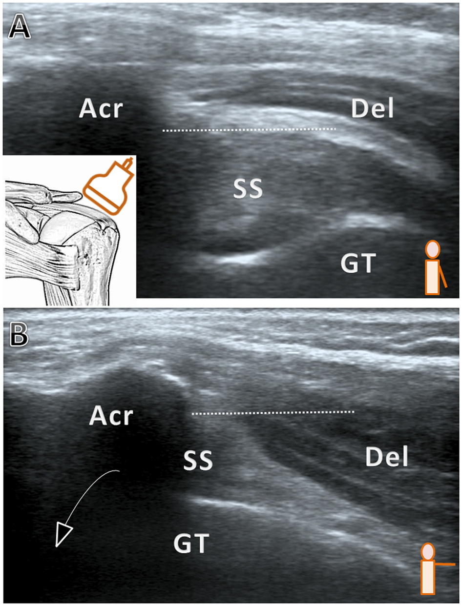 Association of Bicipital Peritendinous Effusion with Subacromial ...